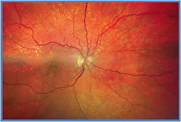Diagnose AMD Early With Protocols | Optometric Management