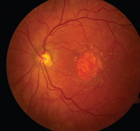 How Widefield Imaging Helps Identify Peripheral Conditions | Optometric ...