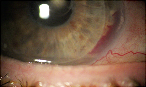 Co-Manage Post Glaucoma Surgery | Optometric Management