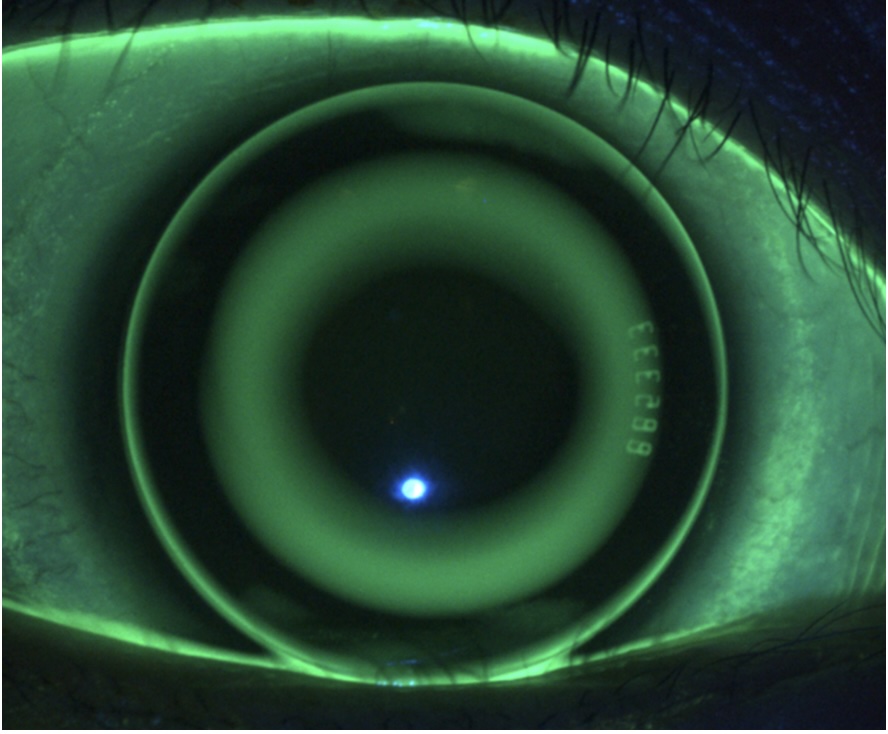 Providing protocols for myopia control using contact lenses ...