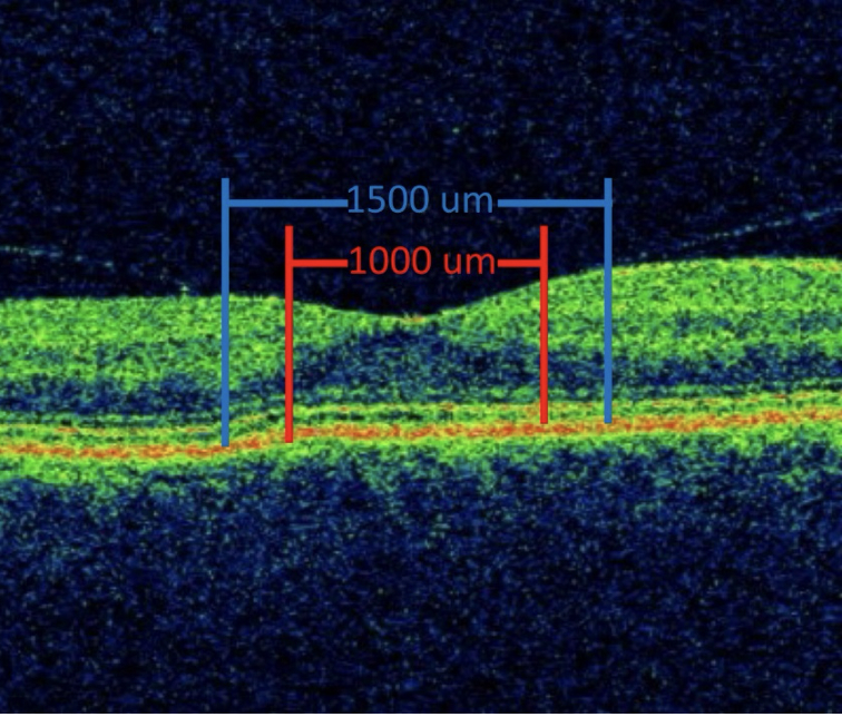 Online Exclusive: Using OCT for vitreoretinal traction syndrome ...