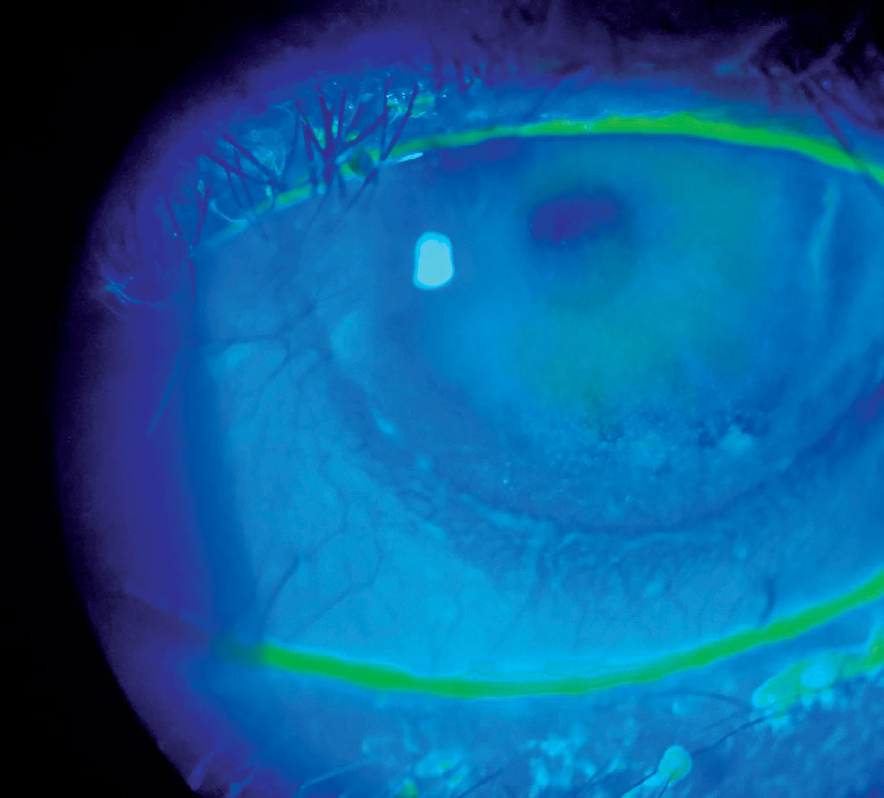 Eye Disease Histoplasmosis Astigmatism Glaucoma Swollen